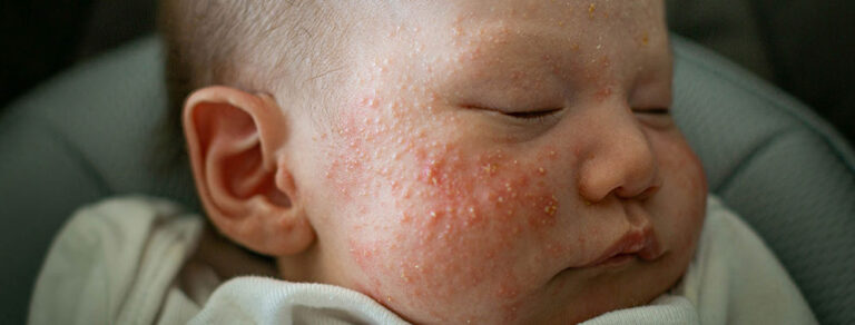 Voss | Miliária ou brotoeja